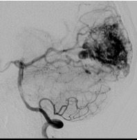 Brain Arteriovenous Malformations (AVM) – Dr. Li-Mei Lin