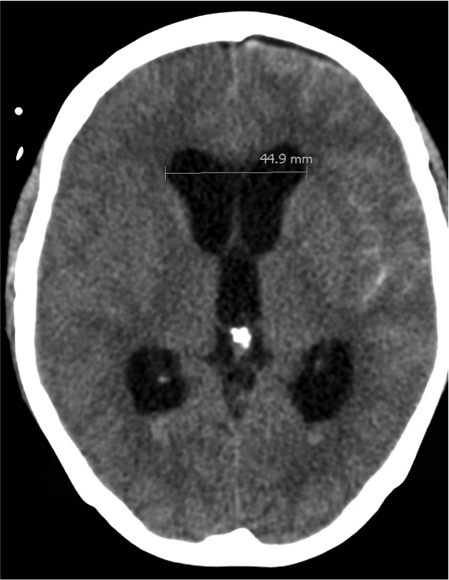 Aneurysmal Subarachnoid Hemorrhage (SAH) – Dr. Li-Mei Lin